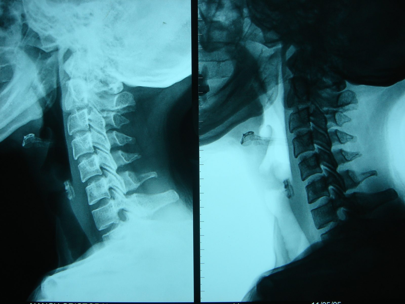 Tráquea y Esófago - Dr. Juan Ore