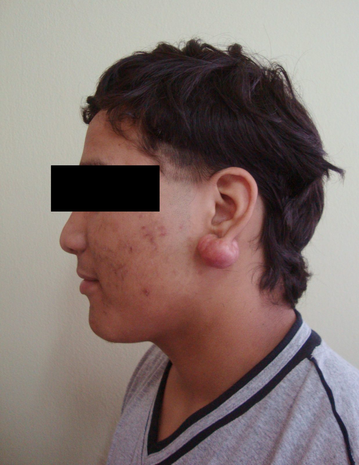 Tumores benignos y malignos - Dr. Juan Ore