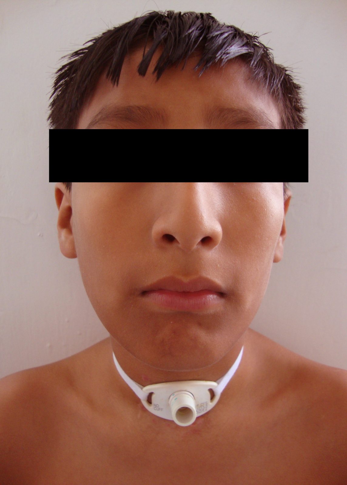 Tráquea y Esófago - Dr. Juan Ore