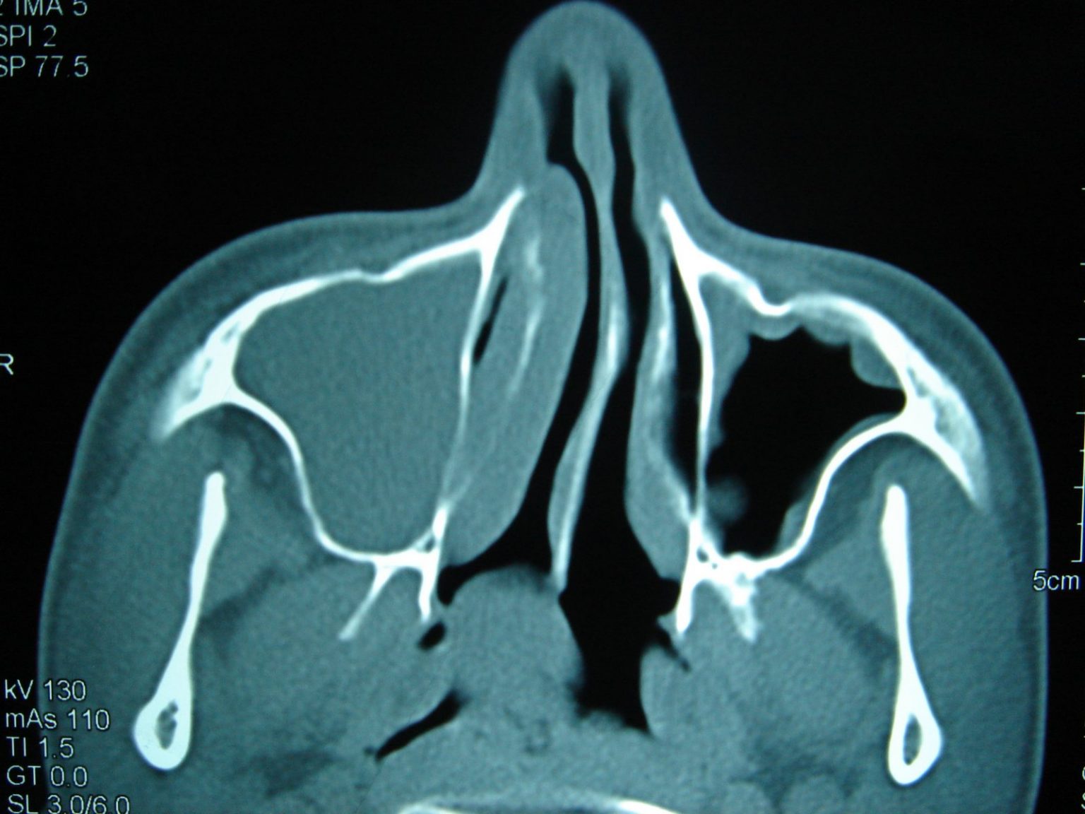 Tumores benignos y malignos - Dr. Juan Ore